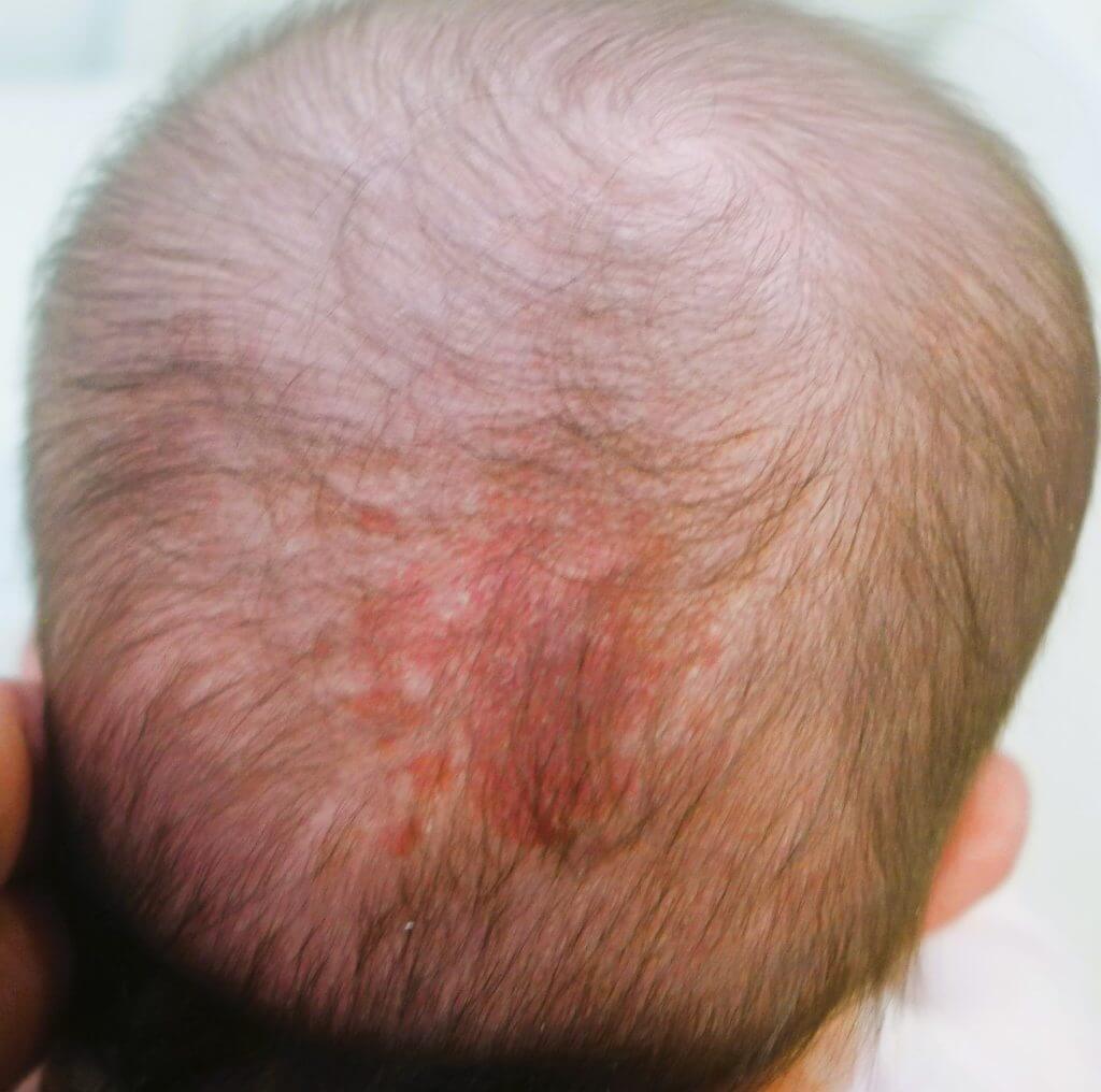 נבוס פלמוס - נגע עורי שכיח בתינוקות